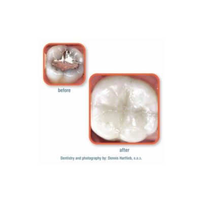 Renamel Posterior Composite