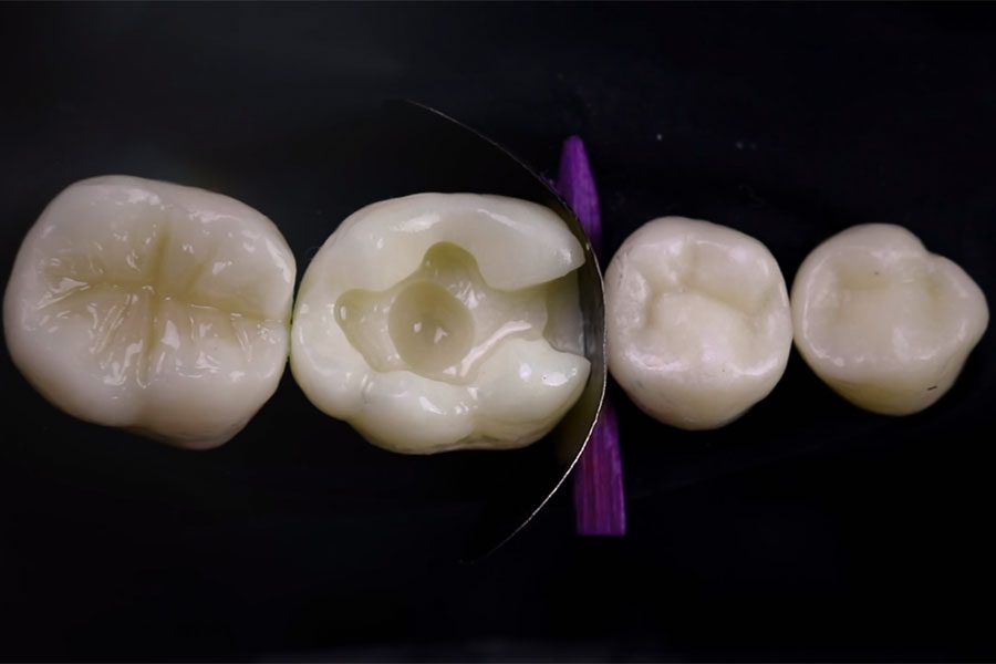 Demonstration of the placement technique for Renamel Bulkfill