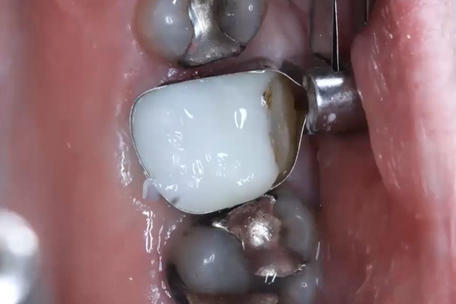 Better Core Build-ups and Posterior Restorations | Cosmedent